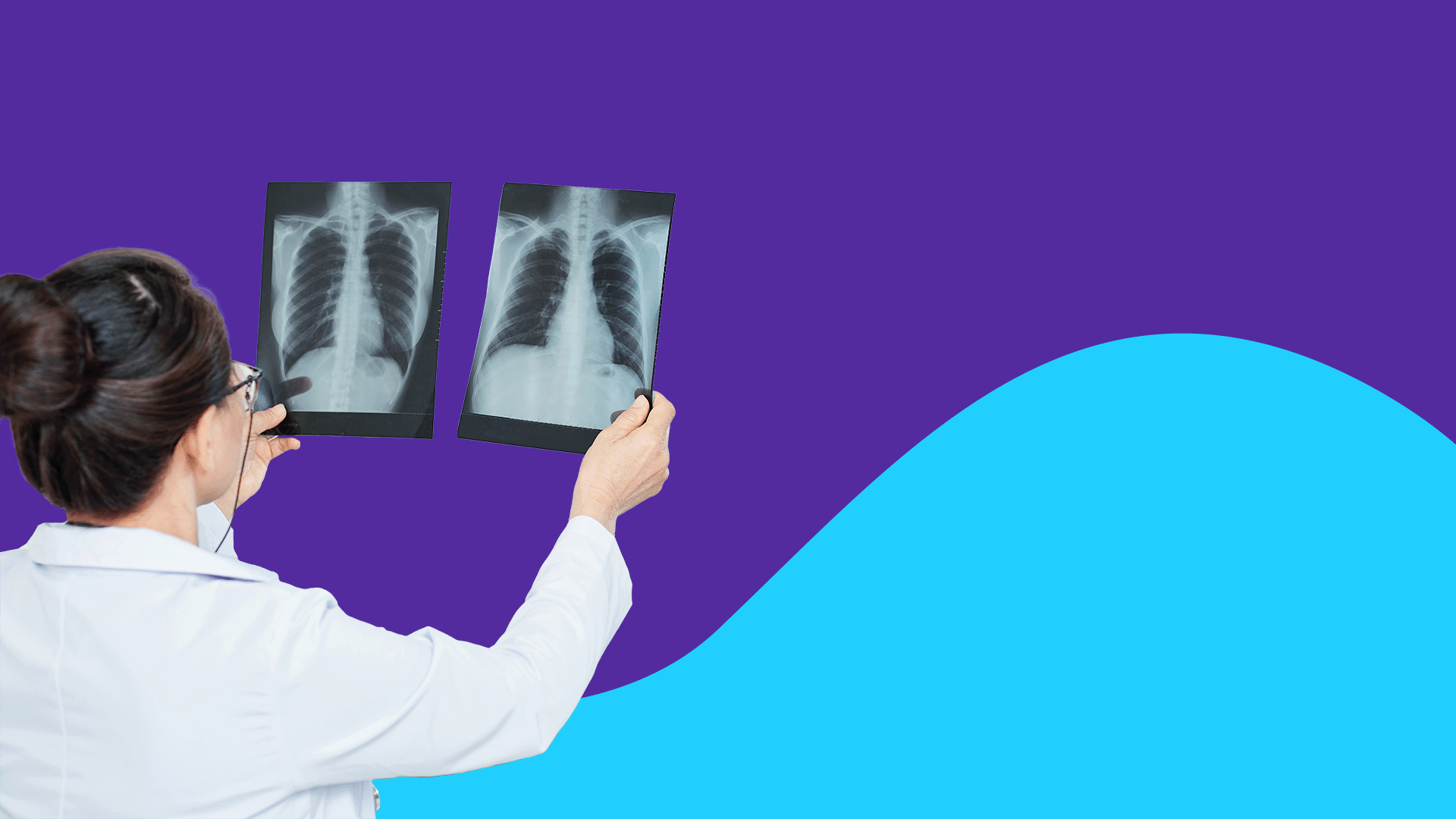Pulmonary Embolism X Ray